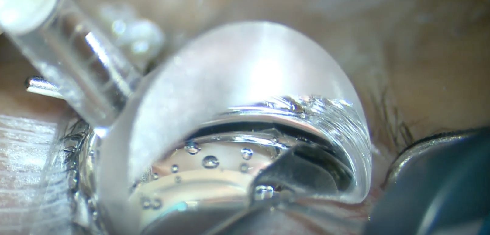 iPrime Canaloplasty and iStent Infinite - Eyetube